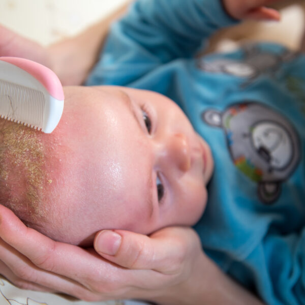 Newborn Rashes and Skin Conditions | Urgent Care for Kids Near Me